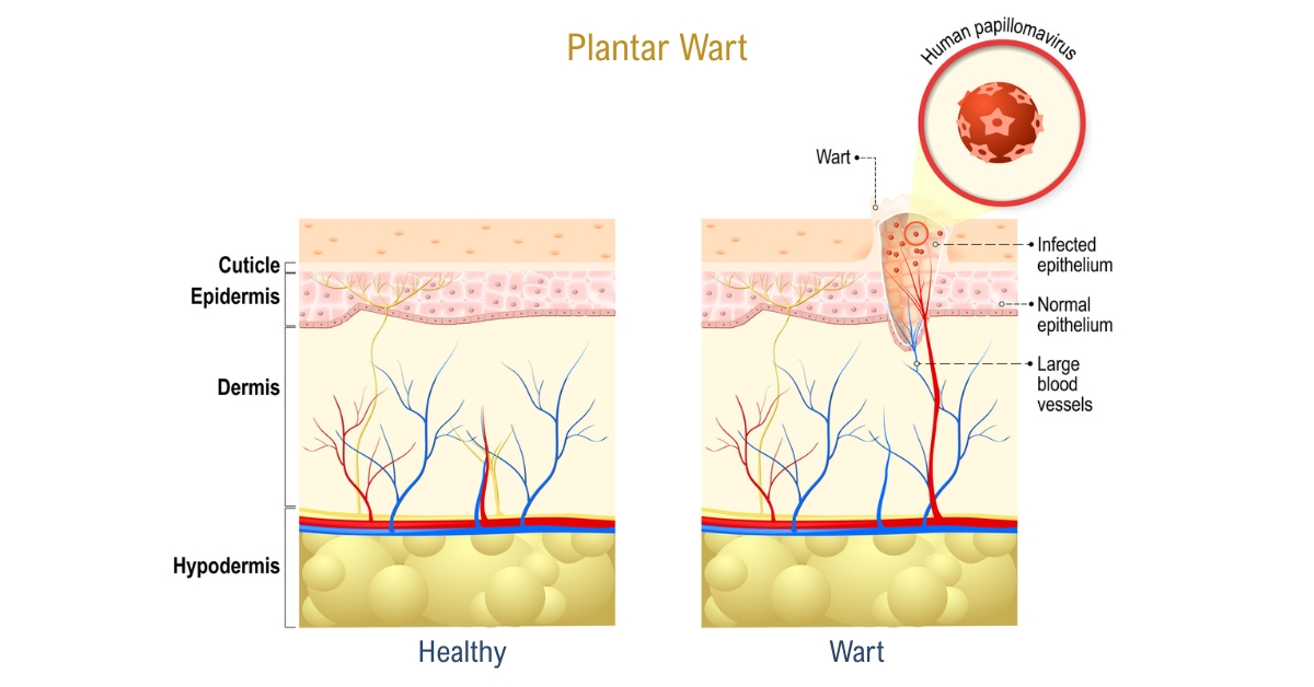 Plantar Wart Podiatry Care: How Podiatrists Help You Heal And Prevent ...