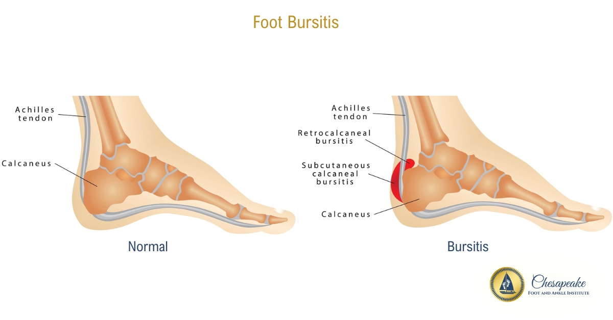 Foot Bursitis Treatment — Heel & Foot Pain Podiatry | Chesapeake Foot ...